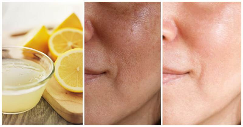 Lemon For Face And Skin: Benefits And How To Use It