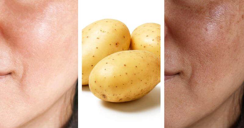 DIY Potato Face Pack Recipes With Benefits For All Skin Types