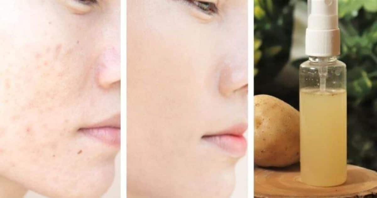 Easy DIY Potato Toner To Bring The Most Clear Skin You've Ever Seen