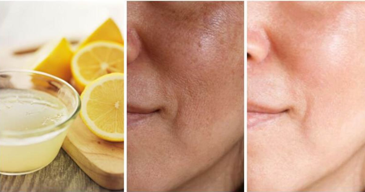 Lemon For Face And Skin: Benefits And How To Use It