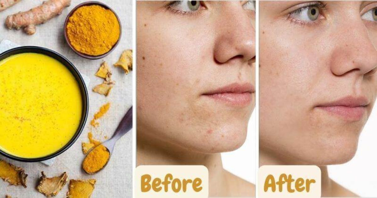 Uptan Remedies To Upgrade Your Skin