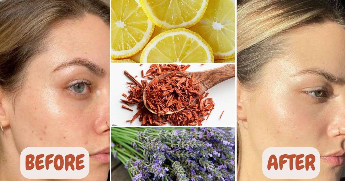 3 Most Effective Essential Oils To Get Rid Of Dark Spots On Your Face