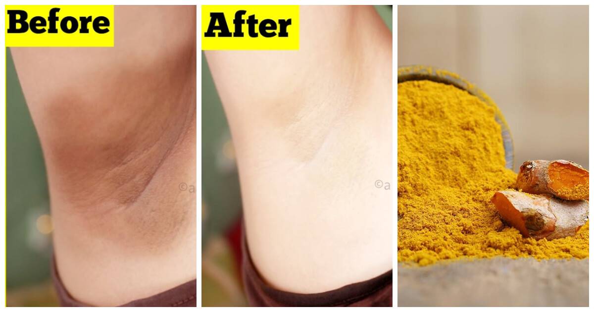 6 DIY Remedies To Lighten Your Dark Armpits