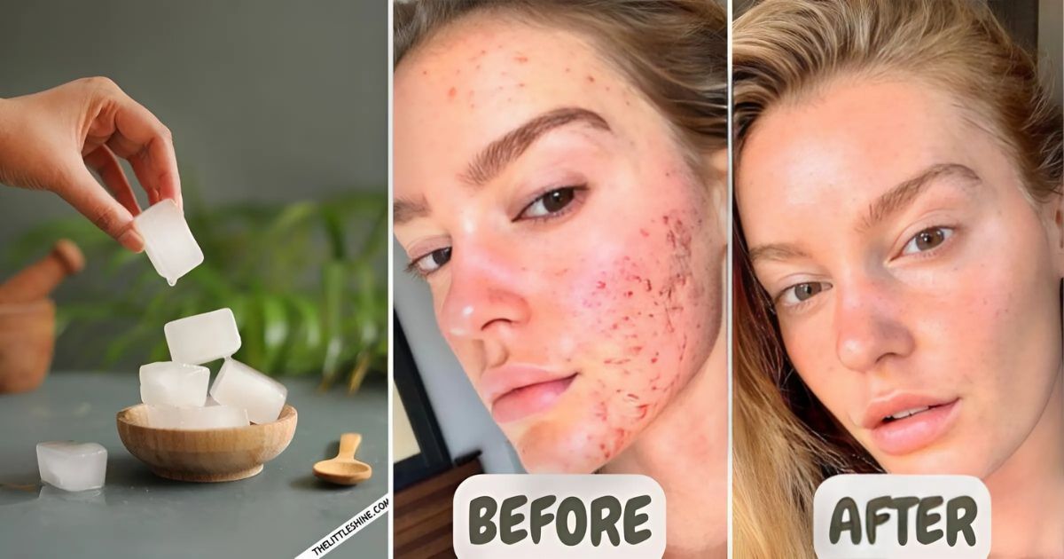 Achieve Your Desirable Clear Skin With DIY Rice Water Ice Cubes
