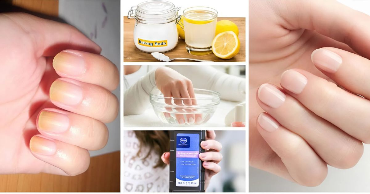 How To Whiten Your Nails Naturally: 5 Effective Ways