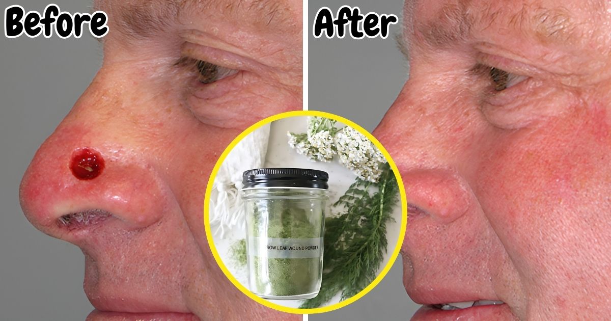 3 Steps to Use Yarrow for Stopping Bleeding Safely And Effectively