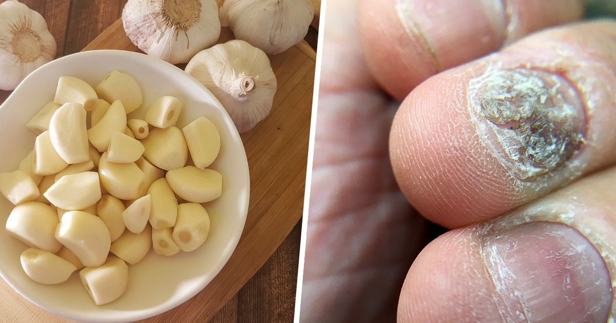 Nail Fungus Gone in Days with Garlic: A Simple and Effective Solution