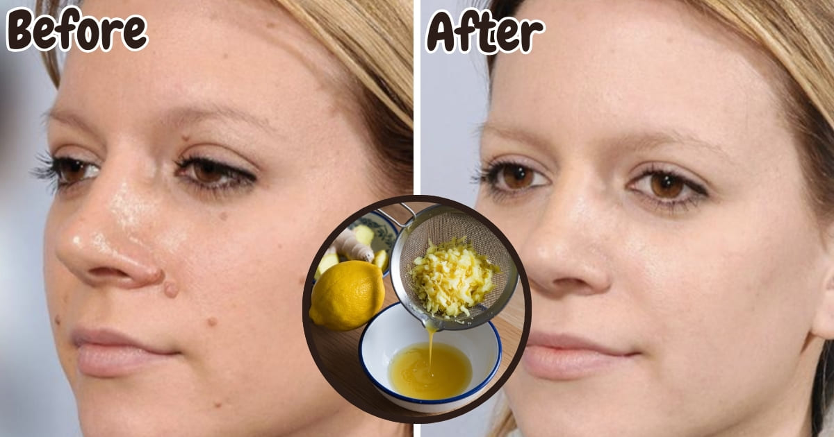 8 Amazing Benefits of Using Lemon and Ginger to Remove Skin Tags