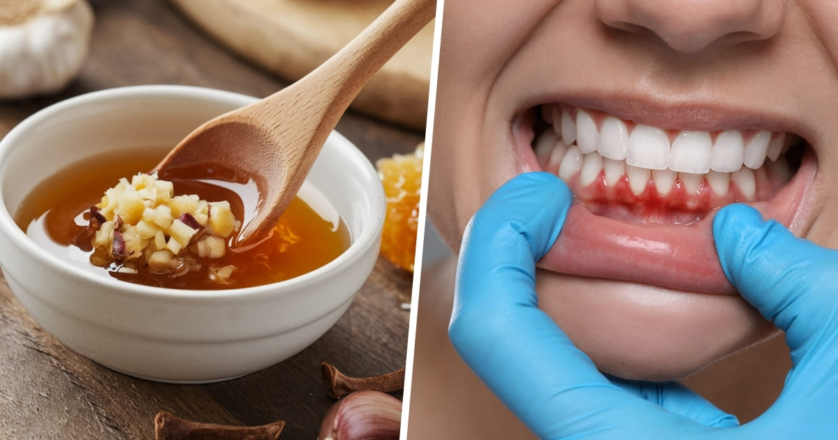 The Healing Power of Garlic, Cloves, and Honey: 10 Health Benefits You ...