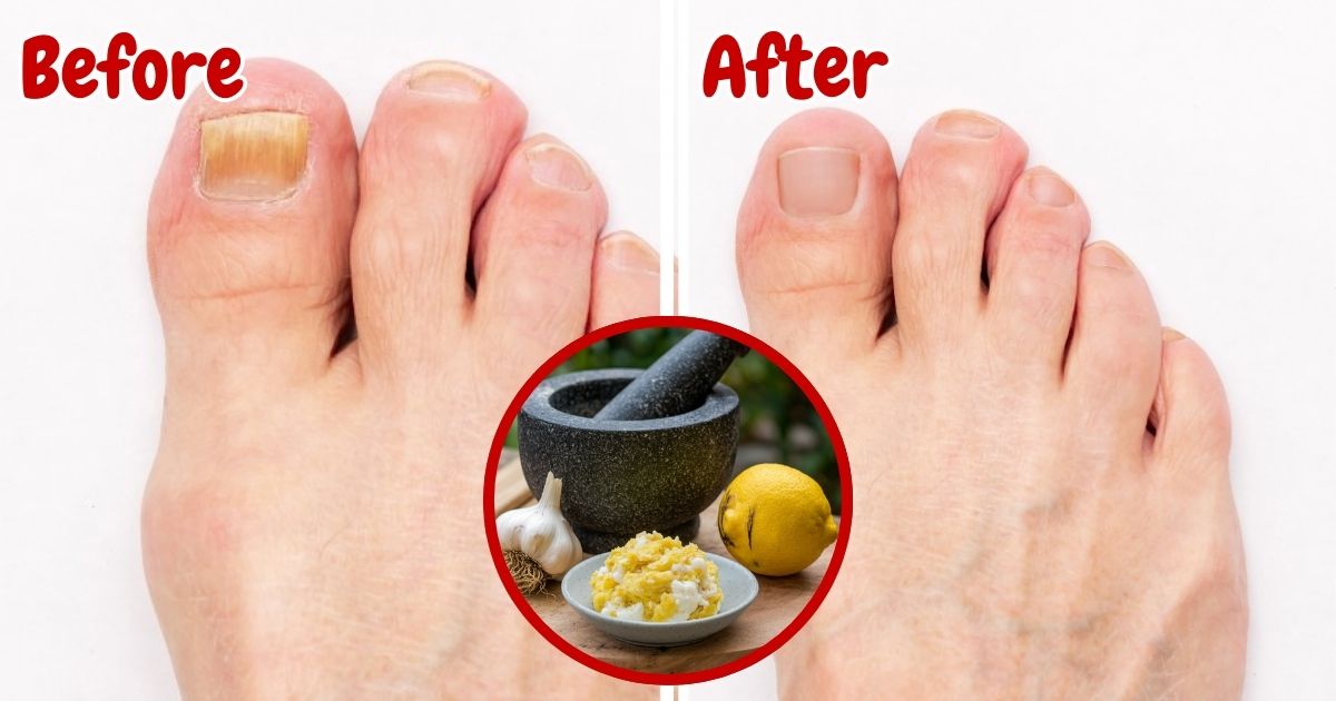 The Life-Changing Health Benefits of Mixing Garlic and Lemon, A Natural ...