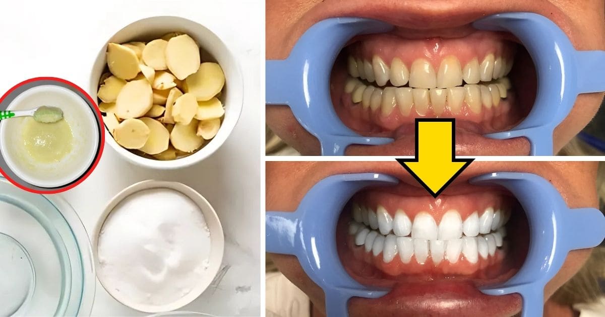 Whiten Your Teeth Instantly with This 2-Minute Ginger and Salt Trick ...