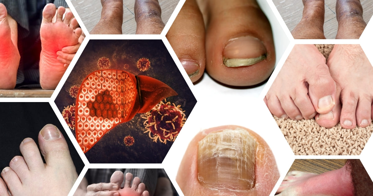 6 Alarming Foot Signs Indicating Liver Problems You Shouldn't Ignore