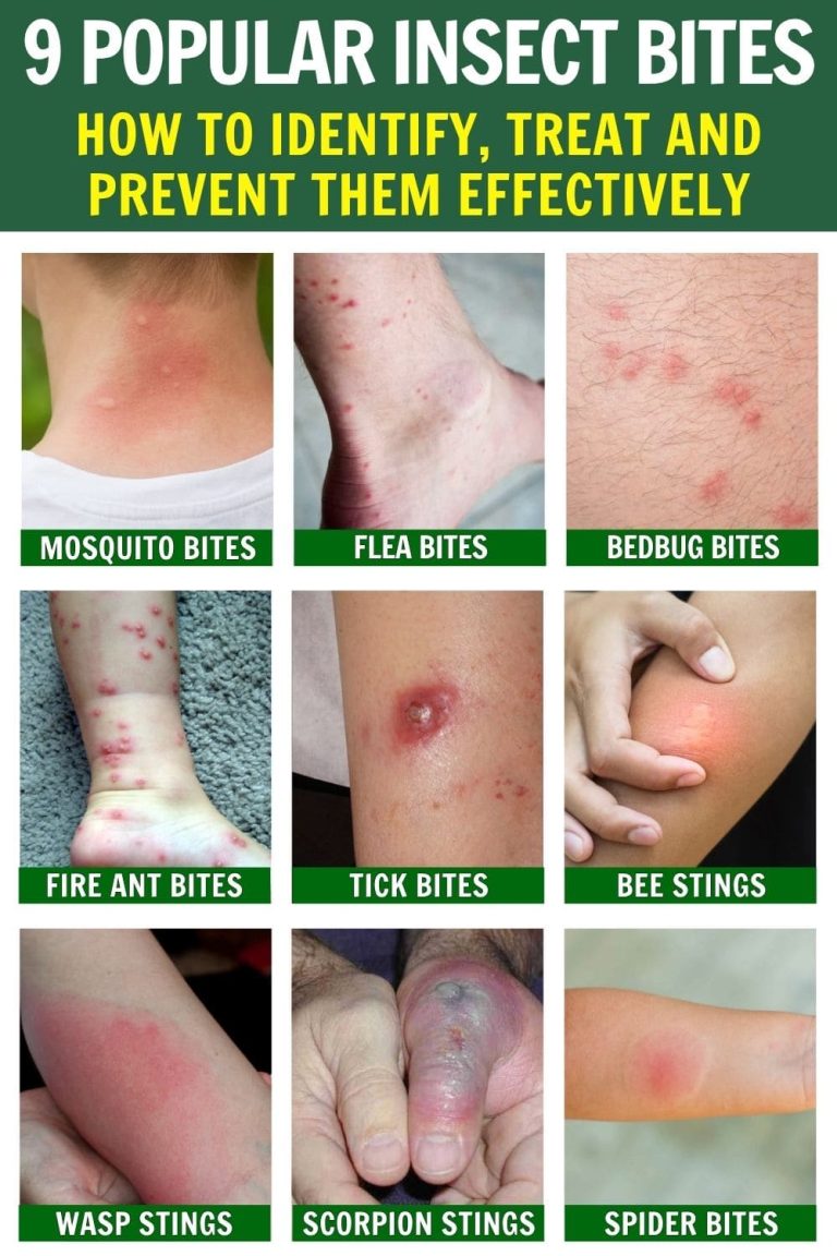 9 Popular Insect Bites and How to Identify, Treat, and Prevent Them ...