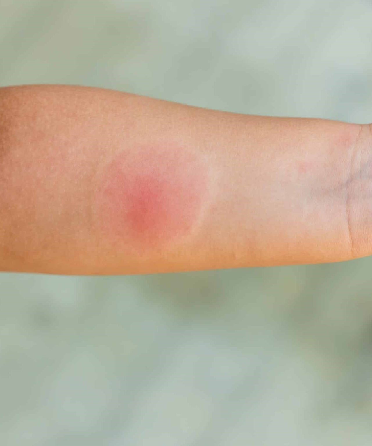 9 Popular Insect Bites and How to Identify, Treat, and Prevent Them ...
